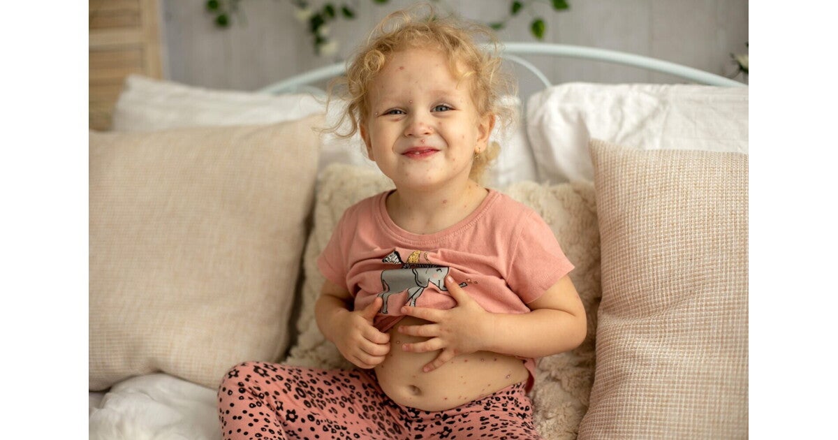 Ce simptome apar in varicela | Nestle Baby Club